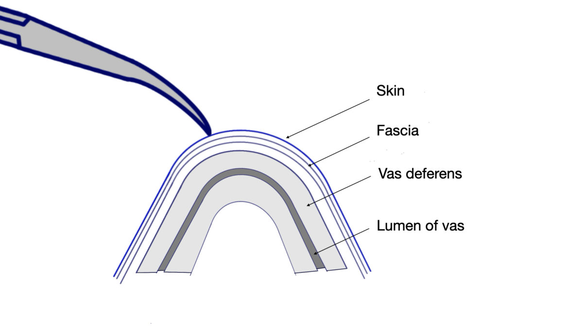 The first puncture – Vasectomy Resources