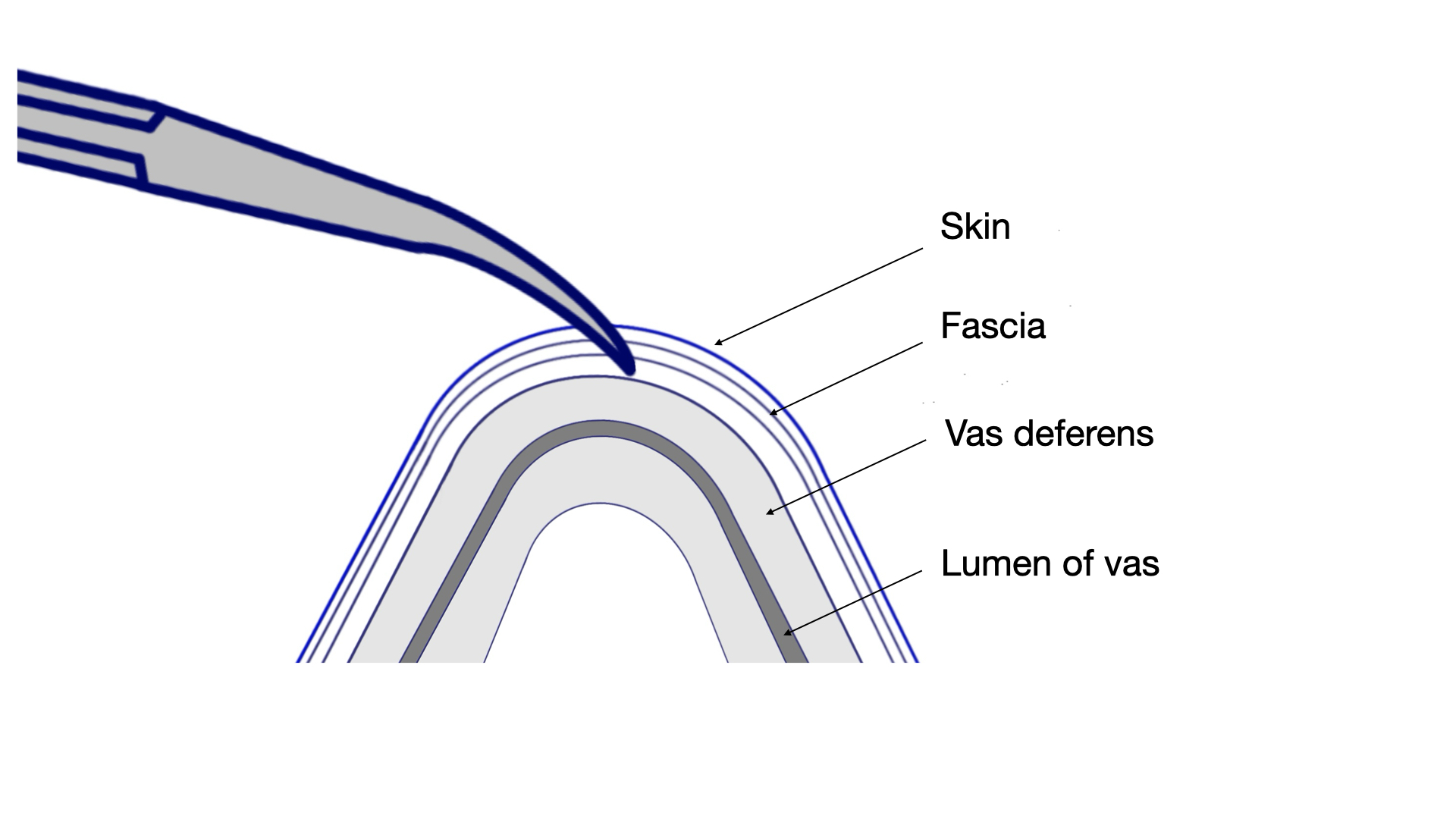 The first puncture – Vasectomy Resources