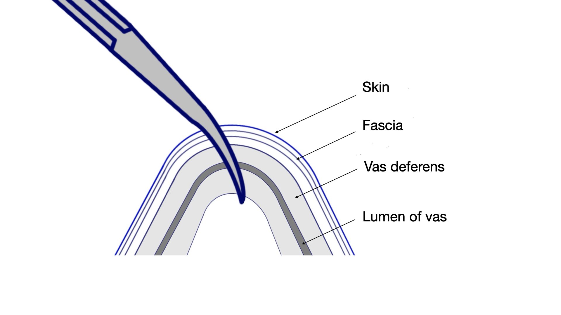 The first puncture – Vasectomy Resources