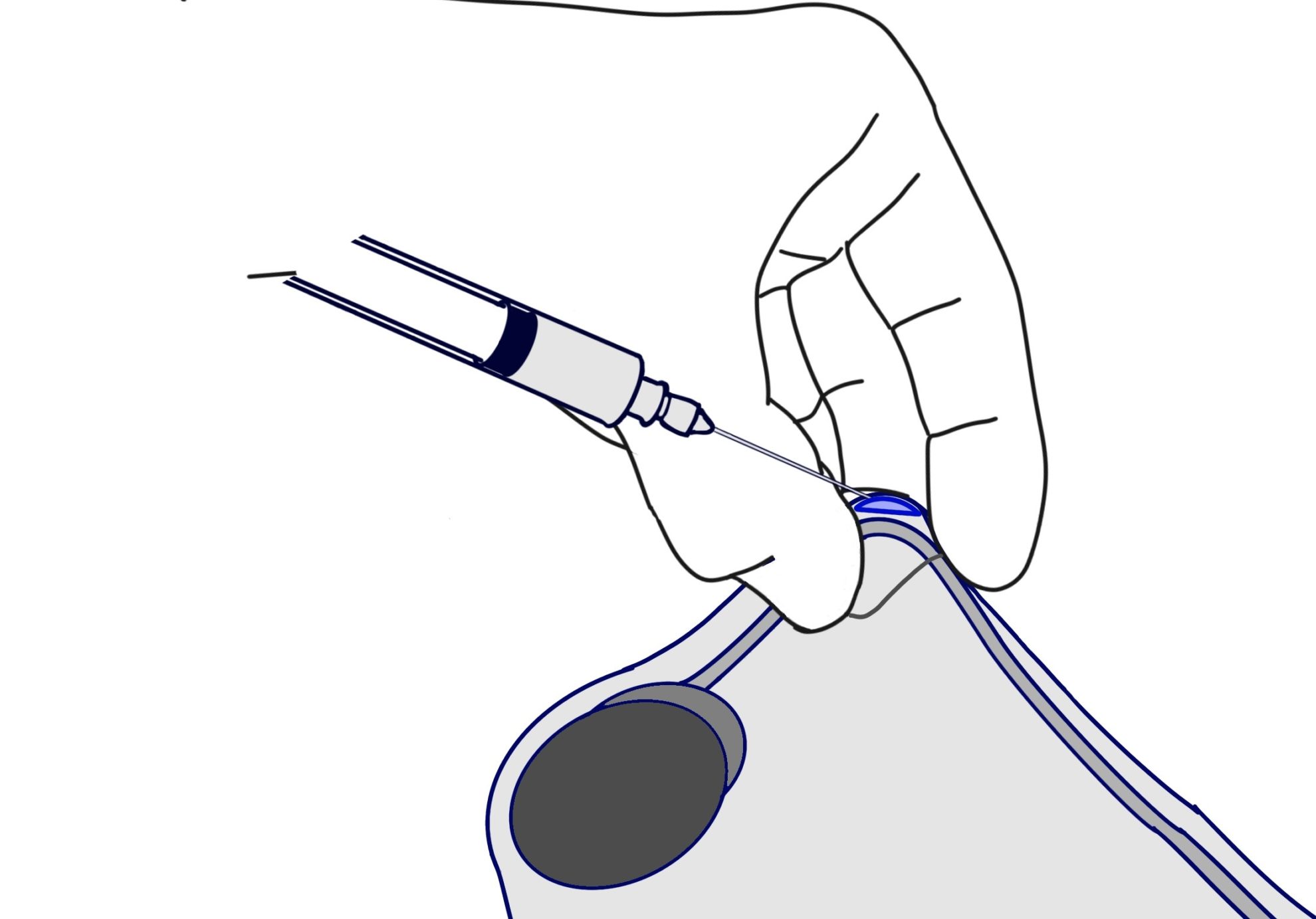 Anesthesia with Mini-Needle – Vasectomy Resources