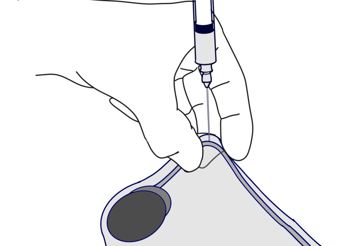 Anesthesia with Mini-Needle – Vasectomy Resources