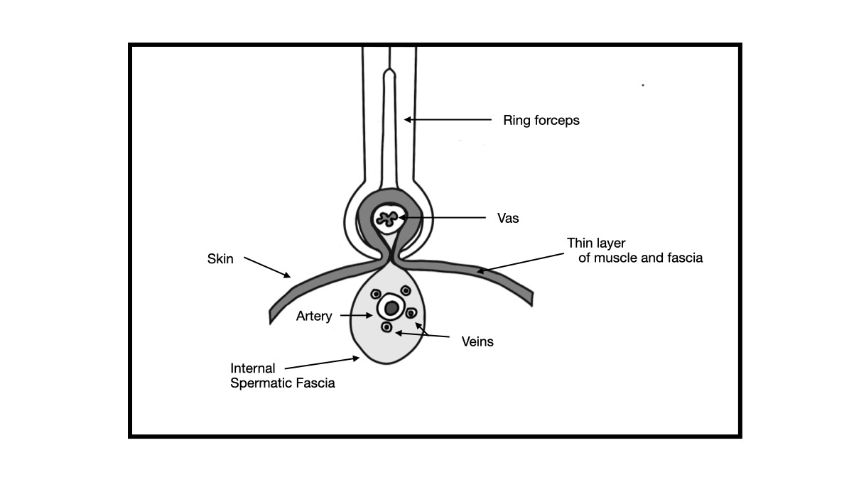 Anatomy for Vasectomy – Vasectomy Resources