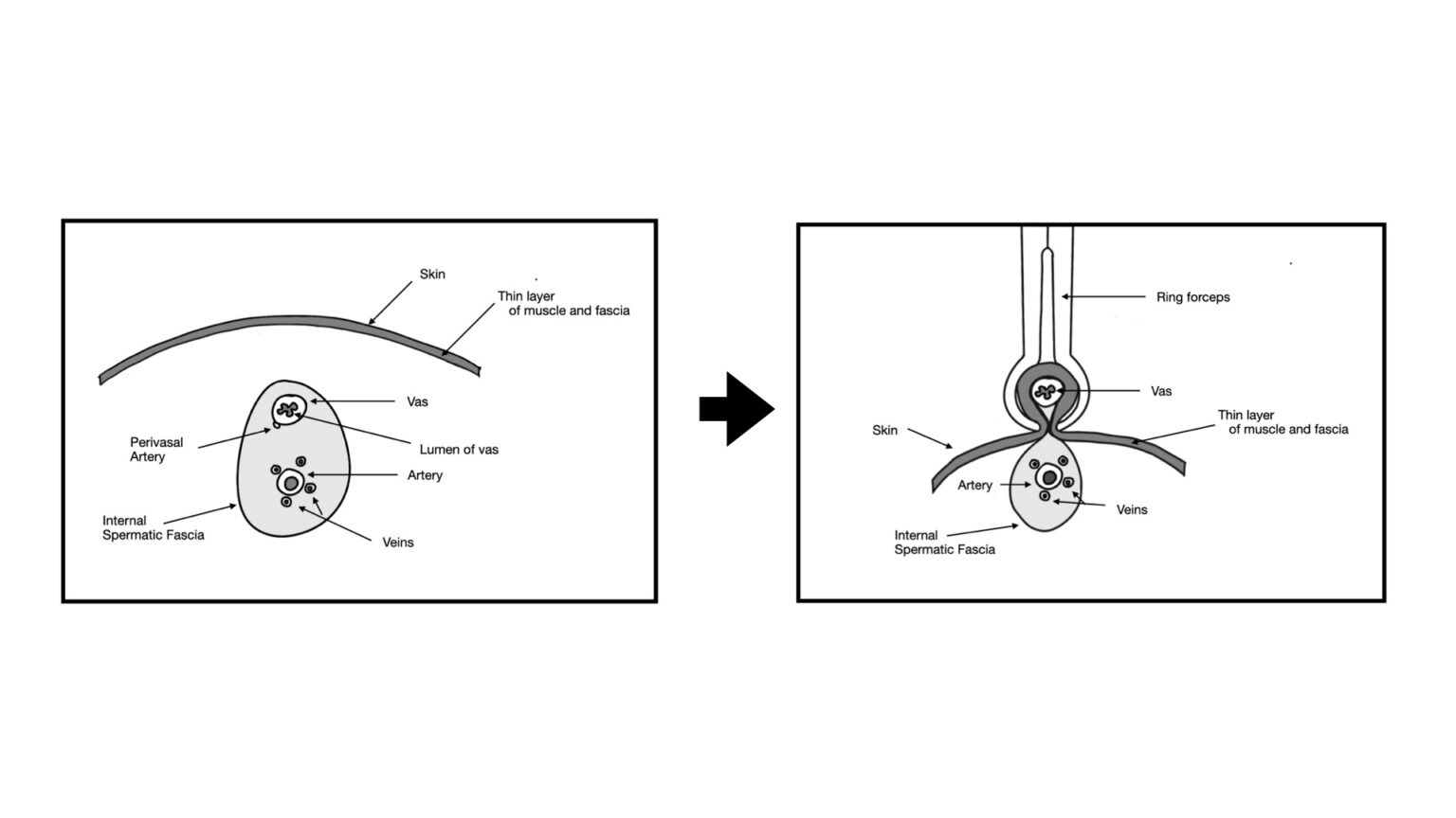 Anatomy for Vasectomy – Vasectomy Resources